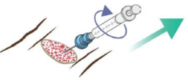 Intraosseous (IO) Access | Defence Medical Services